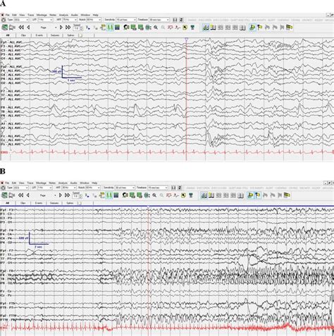 Eeg Demonstrating Focal Slowing Focal Spikes And A Focal Onset