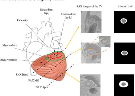 Figure 1 From Automatic Left Ventricle Segmentation From Short Axis Cardiac Mri Images Based On