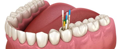 The Benefits Of Endodontic Treatment A Comprehensive Guide