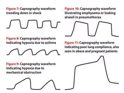 Capnography Pptx