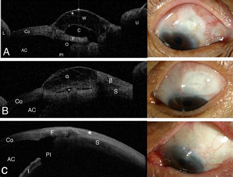 Imaging Of Trabeculectomy Blebs Using Anterior Segment Optical My Xxx