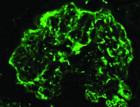 Acute Post Streptococcal Glomerulonephritis Medical Junction