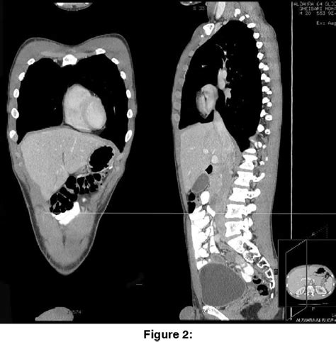 Figure 2 From Radiologic Manifestations Of Chronic Constipation In Ct
