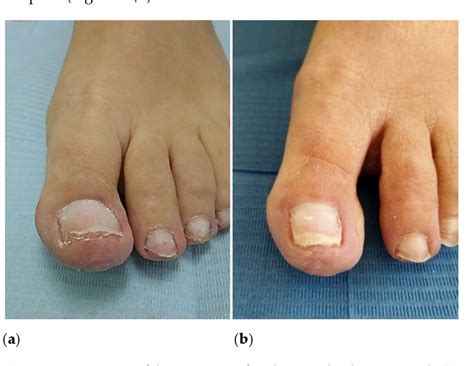Figure 1 From Hallux Partial Necrosis Associated With Antiphospholipid