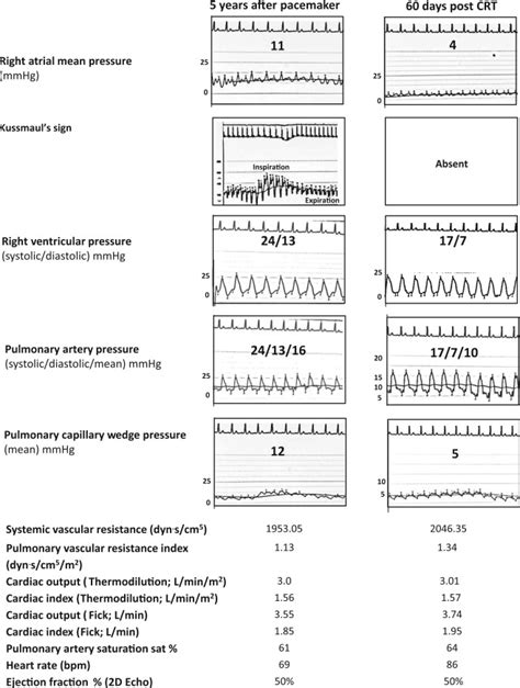Effect Of Biventricular Pacing On Right Sided Hemodynamics In A Download Scientific Diagram