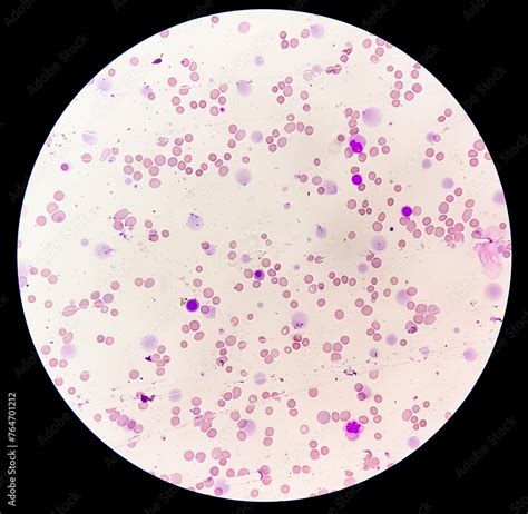 Photomicrograph Of Hematological Slide Showing Severe Anemia Hemolytic Anemia Iron Deficiency