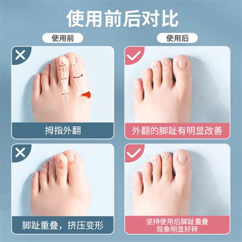 脚趾矫正器大脚趾拇指外翻纠正神器脚趾重叠分趾器男女士可以穿鞋虎窝淘