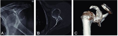 Engaging Hill Sachs Lesion With Hill Sachs Lesion Paralleling The