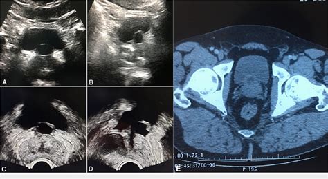 Ultrasound Ct Image Showing An Anteriorly Placed Midline Prostatic Cyst Download Scientific
