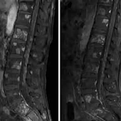 Mri Sacral Spine With Contrast Medifyhome