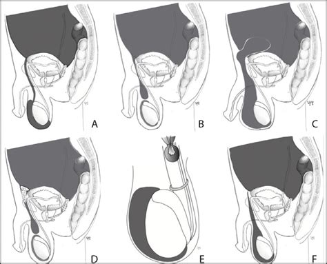 Classifying Hydroceles Of The Pelvis And Groin An Overview Of Etiology