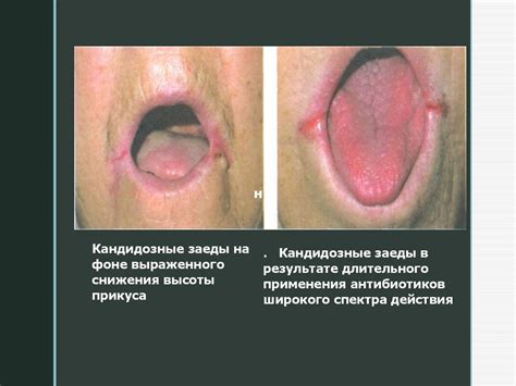 Дифференциальная диагностика кандидоза презентация онлайн