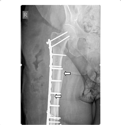 Radiograph Showing The Proximal End Of The Plate With The Onlay Strut Download Scientific