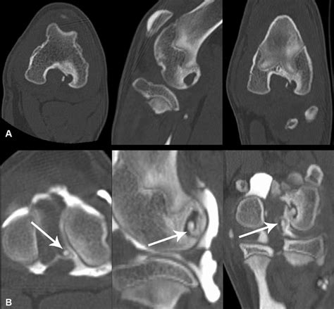 Preoperative CT Scan Examination A And CT Arthrogram B Images Of Download Scientific