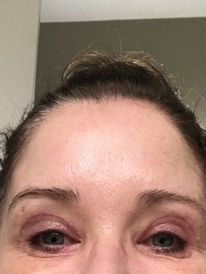 Upper Blepharoplasty Scars