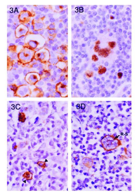 Reed Sternberg R S Cells And Their Variants In Nodular Sclerosing