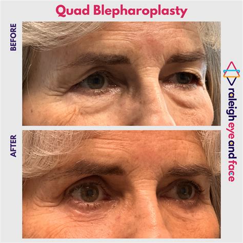 Timing Your Procedures Blepharoplasty Before Or After Cataract Surgery — Raleigh Eye And Face