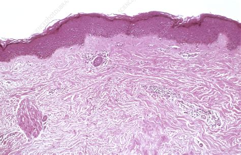 Scleroderma Light Micrograph Stock Image C055 6481 Science Photo