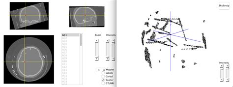 Ieeg Localization Of Intracranial Electrodes Fei