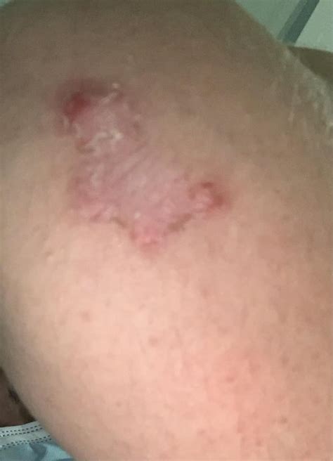 Is This Ring Worm R Medical