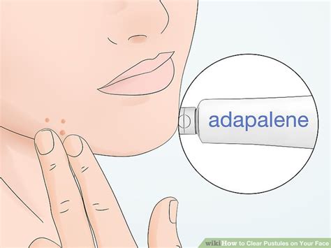 3 Ways To Clear Pustules On Your Face WikiHow Life