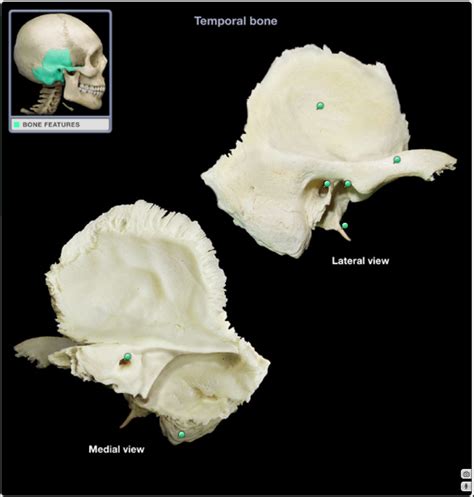 Temporal Bone Markings