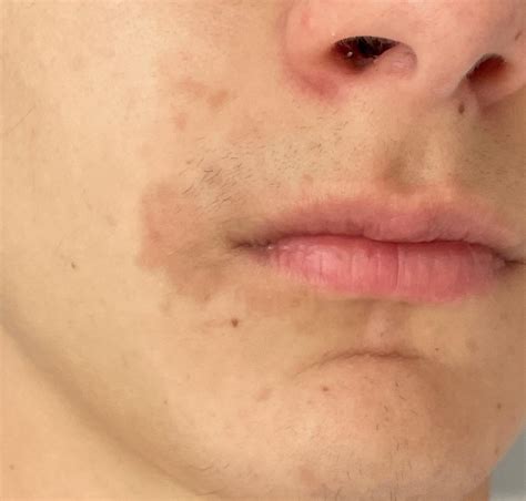 Help Me Please R Dermatologyquestions