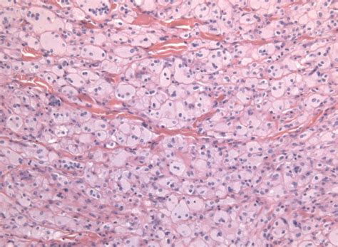 Xantomatosis Cerebrotendinosa Descripción De 4 Casos Actas Dermo