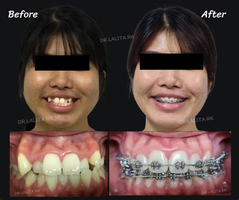 จัดฟันแก้ฟันซ้อนเก ด้วยเทคนิคเฉพาะ