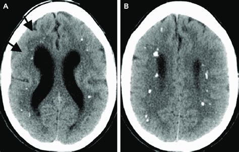 Cureus Intracranial Calcifications In Systemic Lupus 57 Off
