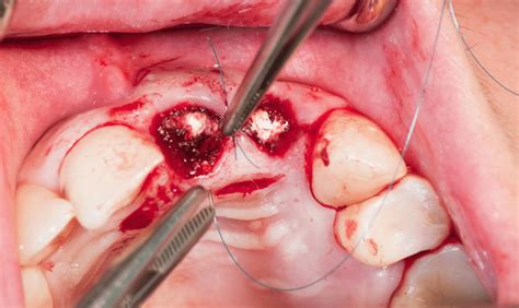 Infected Tooth Socket