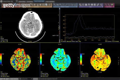 Perfusion Ct Scan Image Of The Brain 3d Rendering Image Analyzing On The Screen Monitor