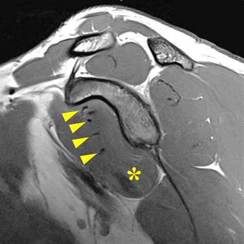 Subscapularis Tendon Tear Radsource