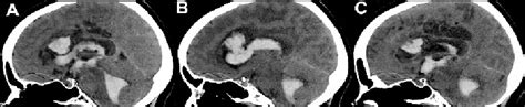 Ct Scan Sagittal Images Showing The Details And Extension Of The