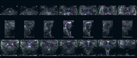 Can Fmriprep Handle Partial Brain Slabs For Functional Data Software Support Neurostars