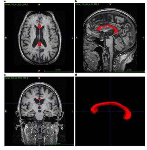 Figure 5 From Semi Automatic Corpus Callosum Segmentation And 3d Visualization Using Active