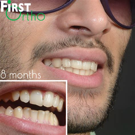 Overbite Reduction With Props First Ortho