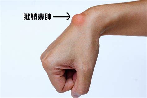 手指头囊肿图片 手指血管瘤图片大人 伤感说说吧