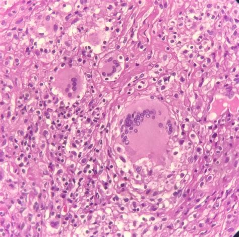Radiopaedia Case Paracoccidioidomycosis Histology Id 54067 Study