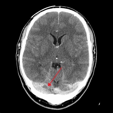 Straight Sinus Unilateral Nonvisualization Of A Transverse Dural Sinus