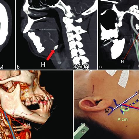 A And B The Mastoid Tip M And Lateral Corner Of The Hyoid Bone H