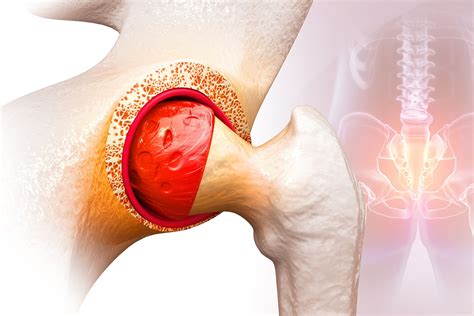 Bursitis In Hip Eremedium