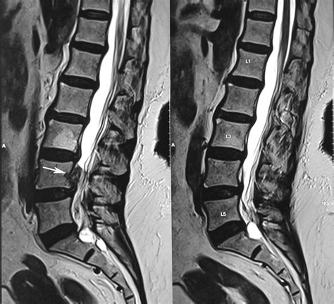 Radiodiagnosis Imaging Is Amazing Interesting Cases Disc Extrusion Mri