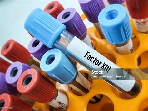 Blood Sample For Factor Xiii Or Fibrin Stabilizing Factor Test