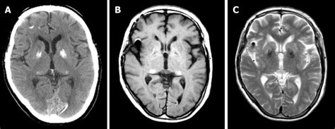 Symptoms Of Brain Calcification