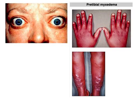 Thyroid Function Test Tft In Simple Way Pdf