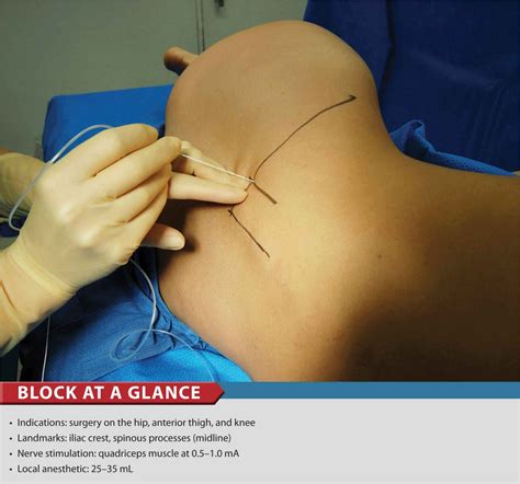 Lumbar Plexus Block