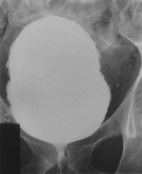 A Cystogram Taken During Video Cystometry In A 28 Year Old Male Download Scientific Diagram