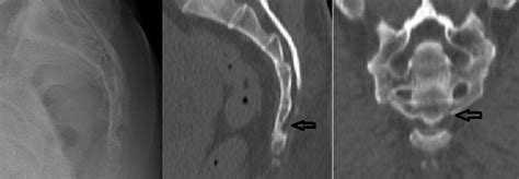 Traumatic Lumbosacral Spine Injury AOSpine Classification ORR