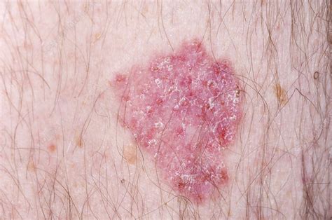 Basal Cell Skin Cancer Spread Stock Image C0110422 Science Photo Library